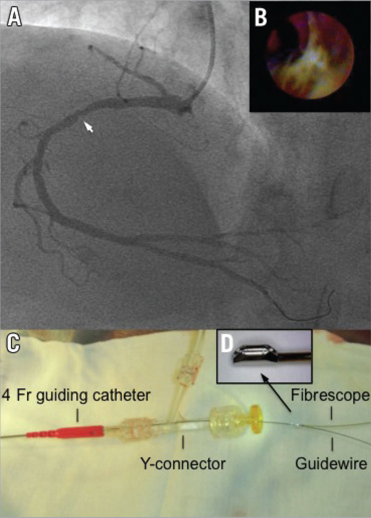 Minimally invasive coronary angioscopy: observation using a new non ...
