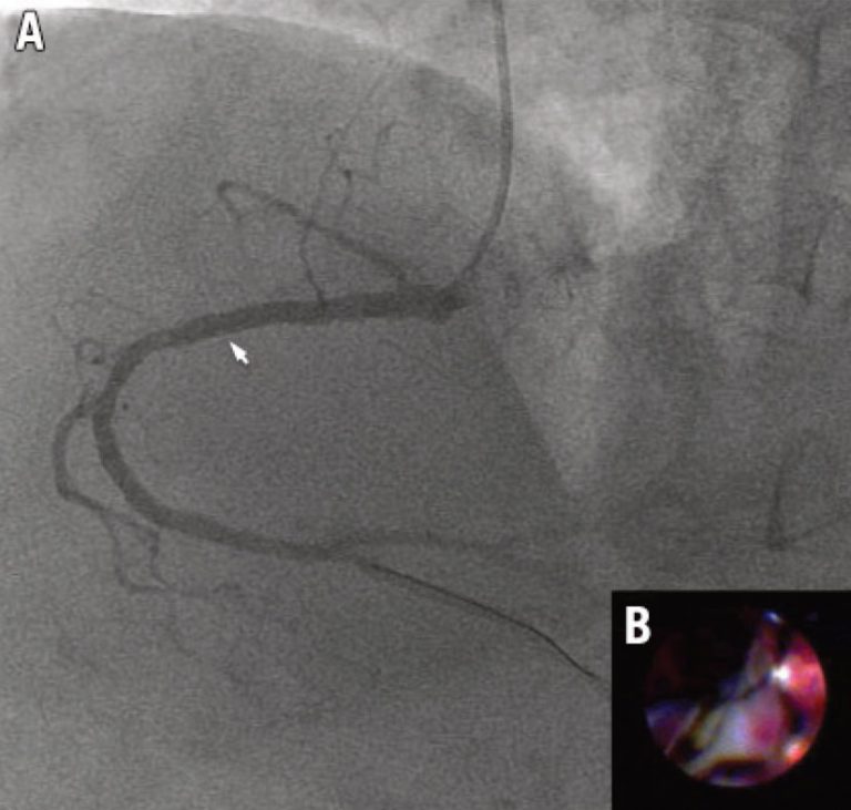 Minimally invasive coronary angioscopy: observation using a new non ...