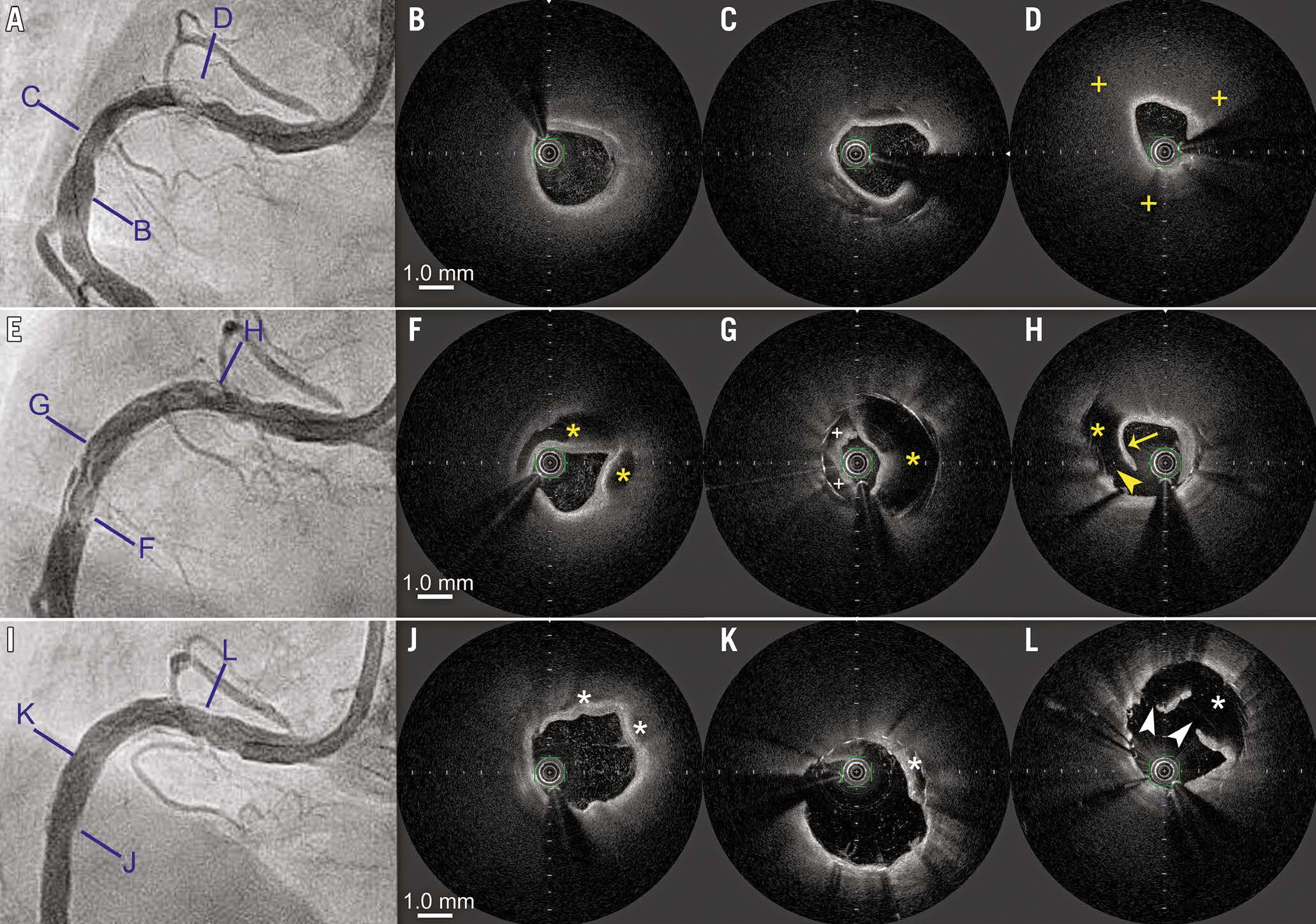 Intraprocedural rupture of neoatherosclerosis causing extensive ...