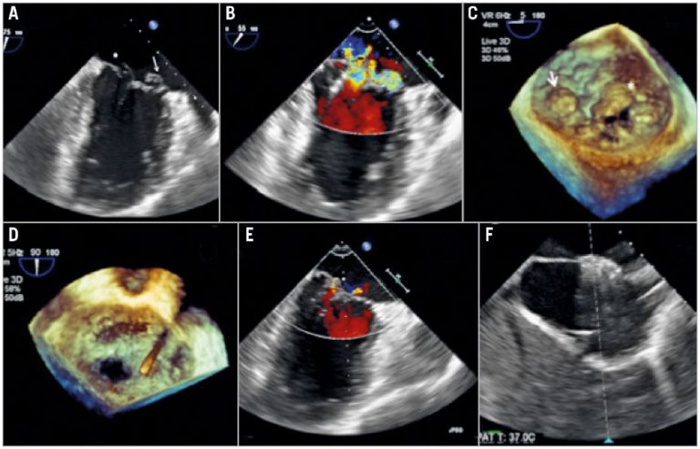 Clipping Barlow’s mitral valve to rescue a patient with acute ...