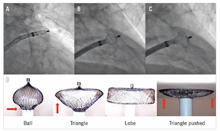 Figure 1. Evolutionary steps in safer deployment of the AMPLATZER ...